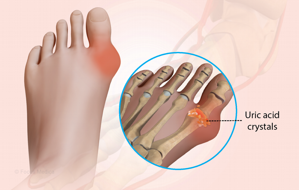 Lemon dan Gout arthiritis